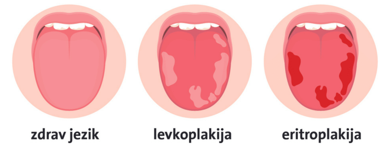 Rak ustne votline - Triglav Zdravje